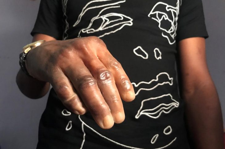 Nigerian artist John Amanam makes dark skin prosthetics for black amputees